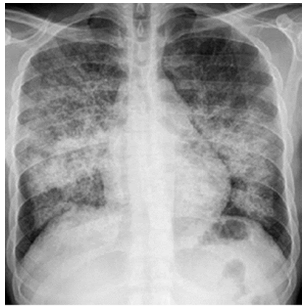 RAMR - Volumen 17, Número 3 Hiperinfección por strongyloides stercoralis