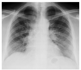 RAMR - Volumen 18, Número 3 Neumonitis por hipersensibilidad: Reporte ...