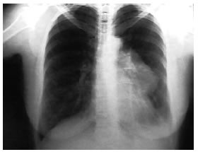 frío Desde artillería cancer de timo profundo golpear ganador