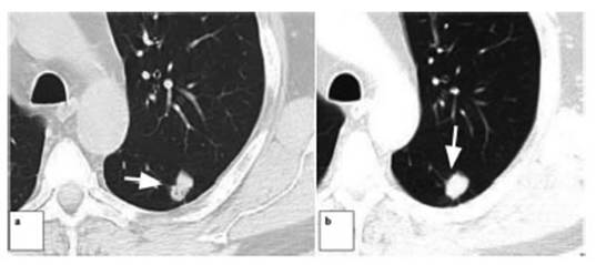 RAMR - Volumen 21, Número 3 - Evaluation of pulmonary nodules on CT ...