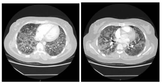 RAMR - Volumen 22, Número 1 - Lesión Pulmonar Aguda Relacionada a ...