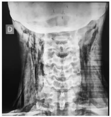 RAMR - Volumen 22, Número 1 - Lesión laringotraqueal secundaria a ...