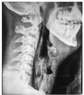 RAMR - Volumen 22, Número 1 - Lesión laringotraqueal secundaria a ...