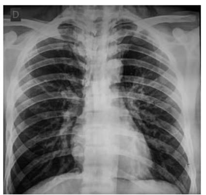 RAMR - Volumen 22, Número 1 - Lesión laringotraqueal secundaria a ...