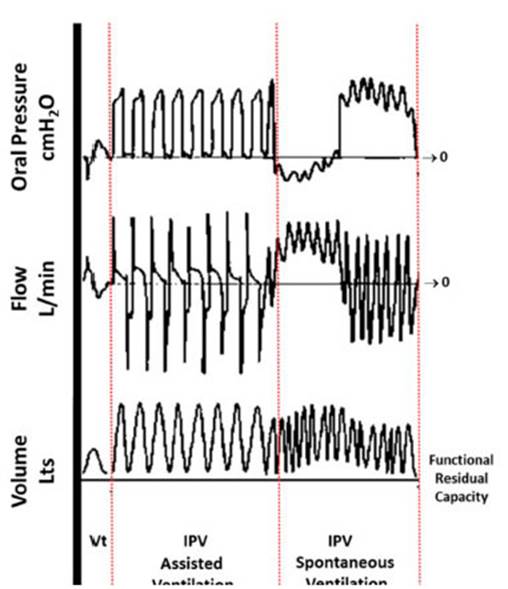RAMR - Volume 22 Number 2 - Use of Intrapulmonary Percussive ...