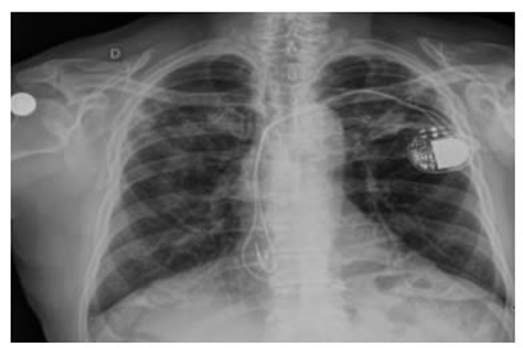 RAMR -Volume 22 Number 3 - Complicated Chronic Silicosis: Findings in ...