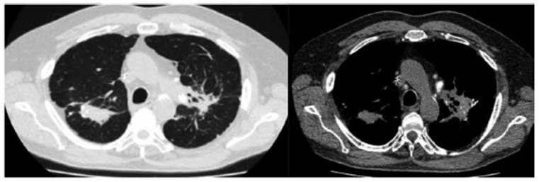 RAMR -Volume 22 Number 3 - Complicated Chronic Silicosis: Findings in ...