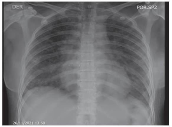 RAMR - Volume 22 Number 4 - Whole Lung Lavage Protocol at Hospital ...