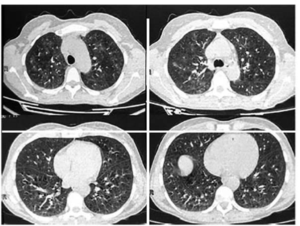 RAMR -Volume 23 Number 1 -Diffuse Infiltrative Lymphocytosis Syndrome ...
