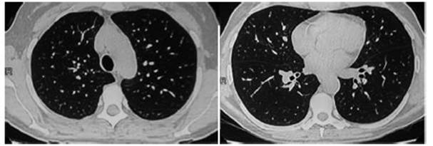 RAMR -Volume 23 Number 1 -Diffuse Infiltrative Lymphocytosis Syndrome ...