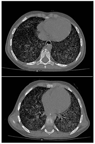 RAMR -Volume 23 Number 1 - Presentation of a Pediatric Case of Ocular ...