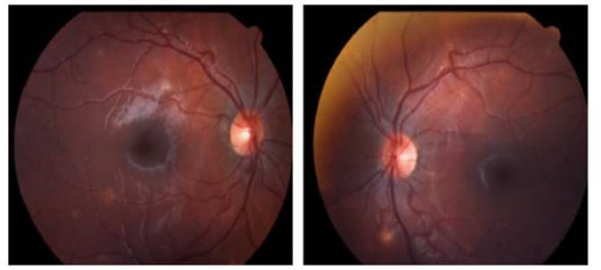 RAMR -Volume 23 Number 1 - Presentation of a Pediatric Case of Ocular ...