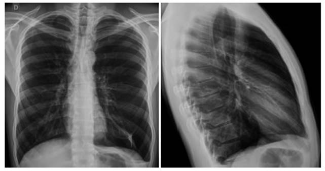RAMR - Volumen 23, Número 2 - Neumotórax espontáneo en paciente con ...