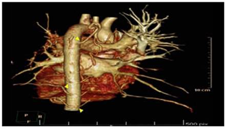 RAMR - Volume 23 Number 2 - Unilateral Agenesis of the Pulmonary Artery ...