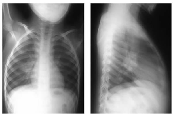 RAMR - Volume 23 Number 4 - Diagnosis of Tuberculosis in Pediatric ...