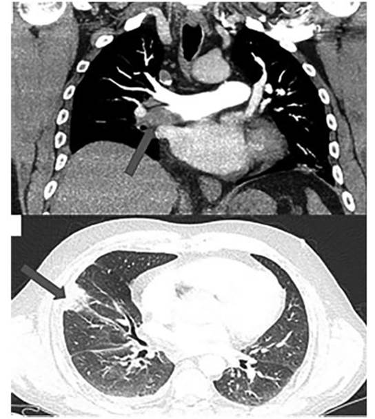 RAMR - Volume 24 Number 2 - Typical Dyspnea in a Patient with an ...