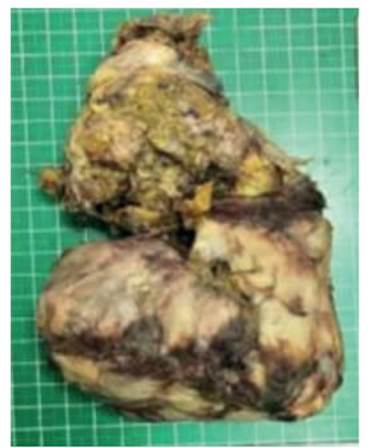 RAMR - Volumen 24, Número 3 Teratoma gigante mediastinal