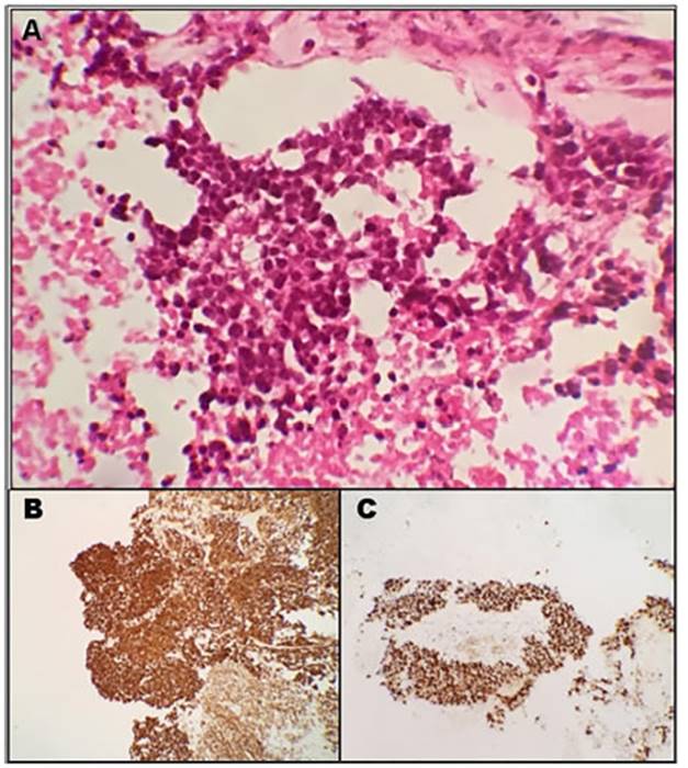 RAMR -Volume 24 Number 3 -- Paraneoplastic Cerebellar Degeneration ...