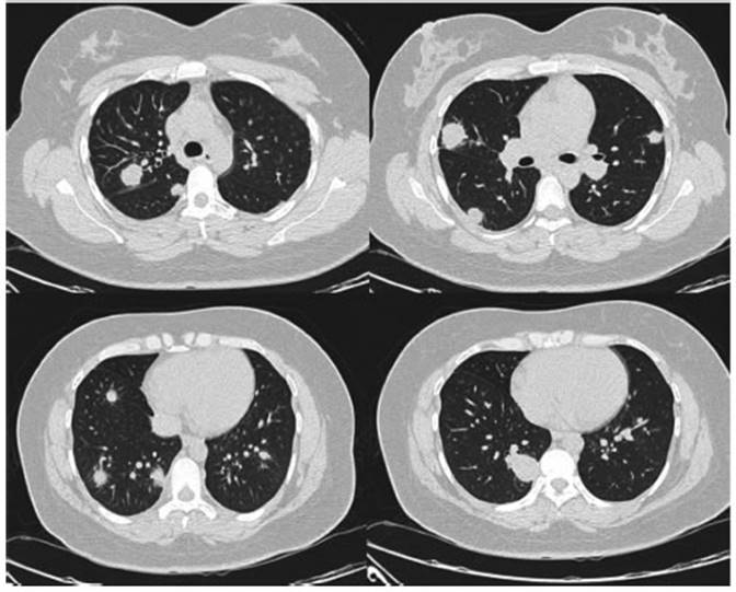 RAMR - Volume 24 Number 3 CT Findings in Organizing Pneumonia