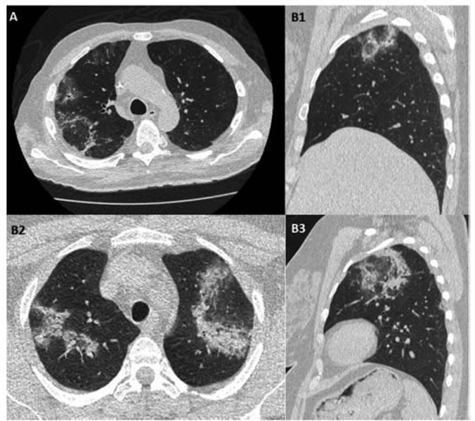 RAMR - Volume 24 Number 3 CT Findings in Organizing Pneumonia