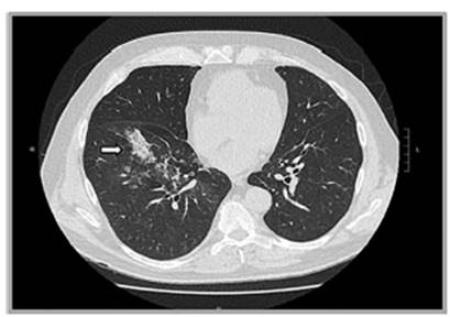 RAMR - Volume 25 Number 2 Hemoptysis and Unilateral Pulmonary Ground ...